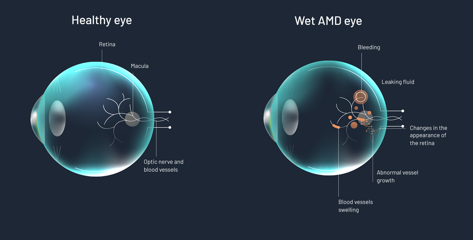 What is wet AMD? | SUSVIMO® (ranibizumab injection)
